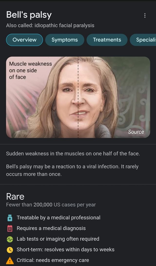 Bell's palsy Also called: idiopathic facial paralysis Overview Symptoms ...