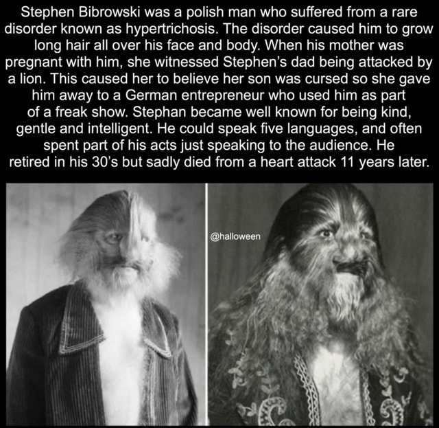 Stephen Bibrowski was a polish man who suffered from a rare disorder ...