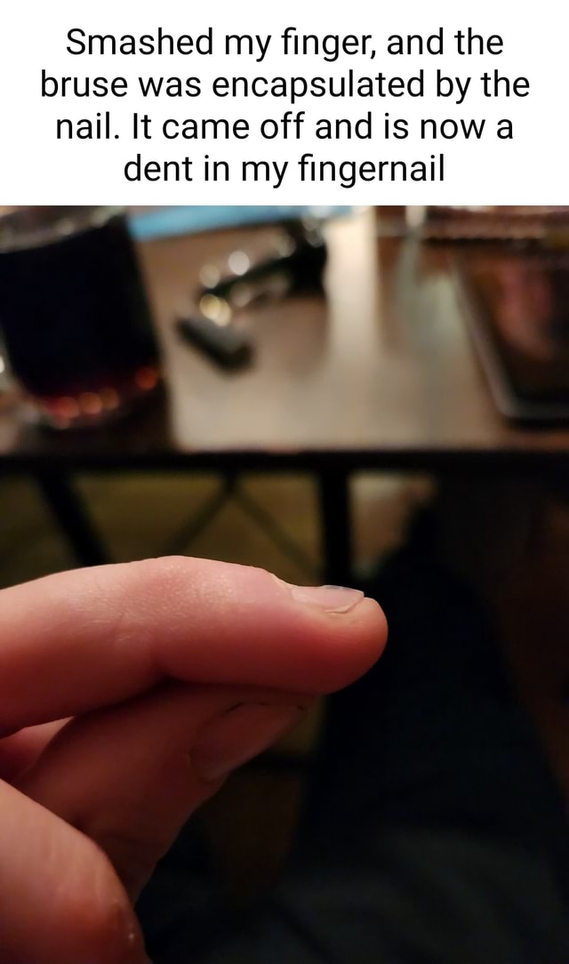 Smashed my finger, and the bruse was encapsulated by the nail. It came ...
