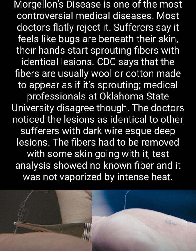Morgellons Disease is one of the most controversial medical diseases ...