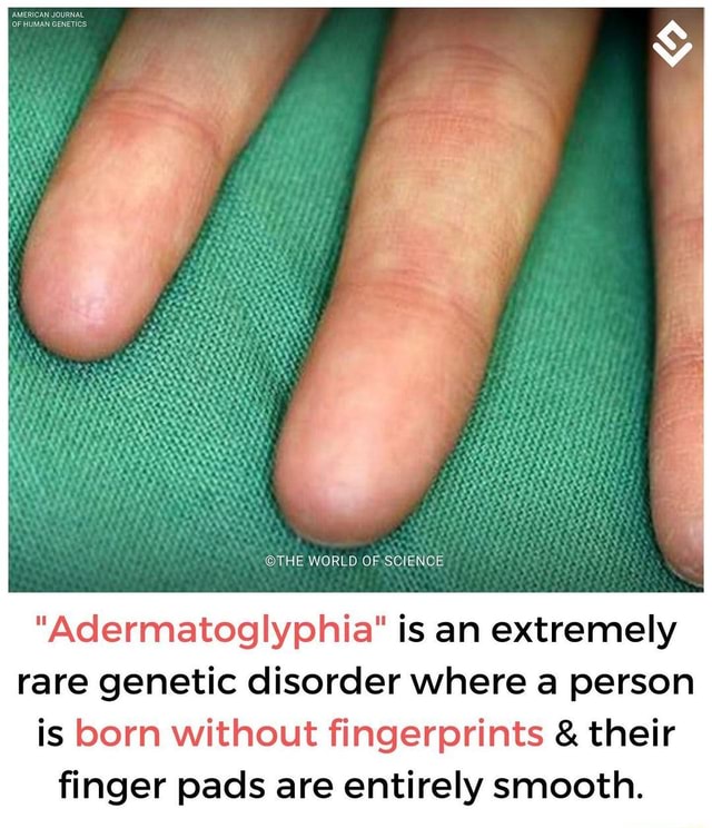 THE WORLD OF SCIENCE "Adermatoglyphia" is an extremely rare genetic ...
