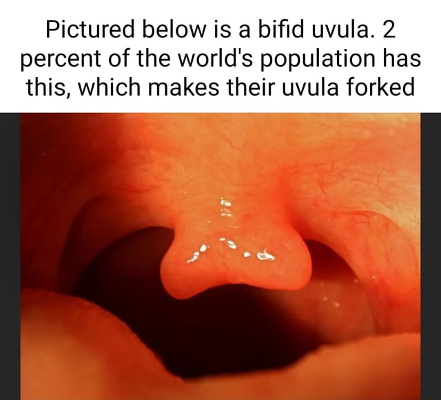 Bifid Uvula Popular Stores | www.micoope.com.gt