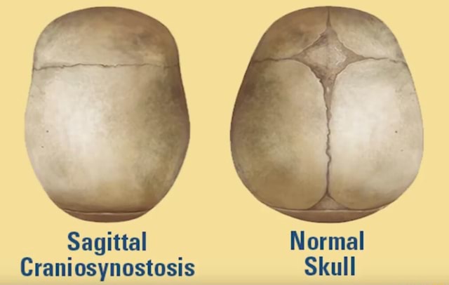 Sagittal Normal Craniosynostosis Skull - iFunny Brazil